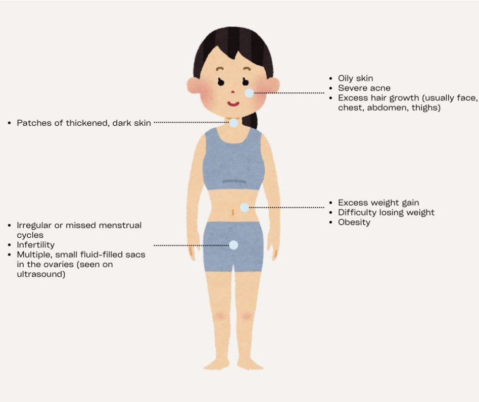 Understanding PCOS | Period Education Project
